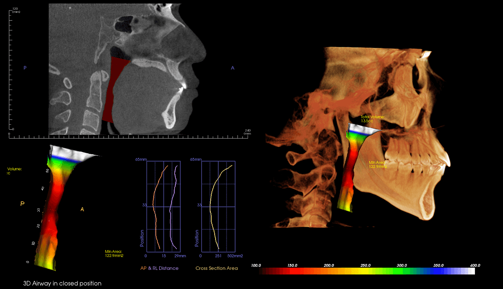 A Comprehensive Guide To Airway Dentistry - Dr. Cheng's Dental Tips