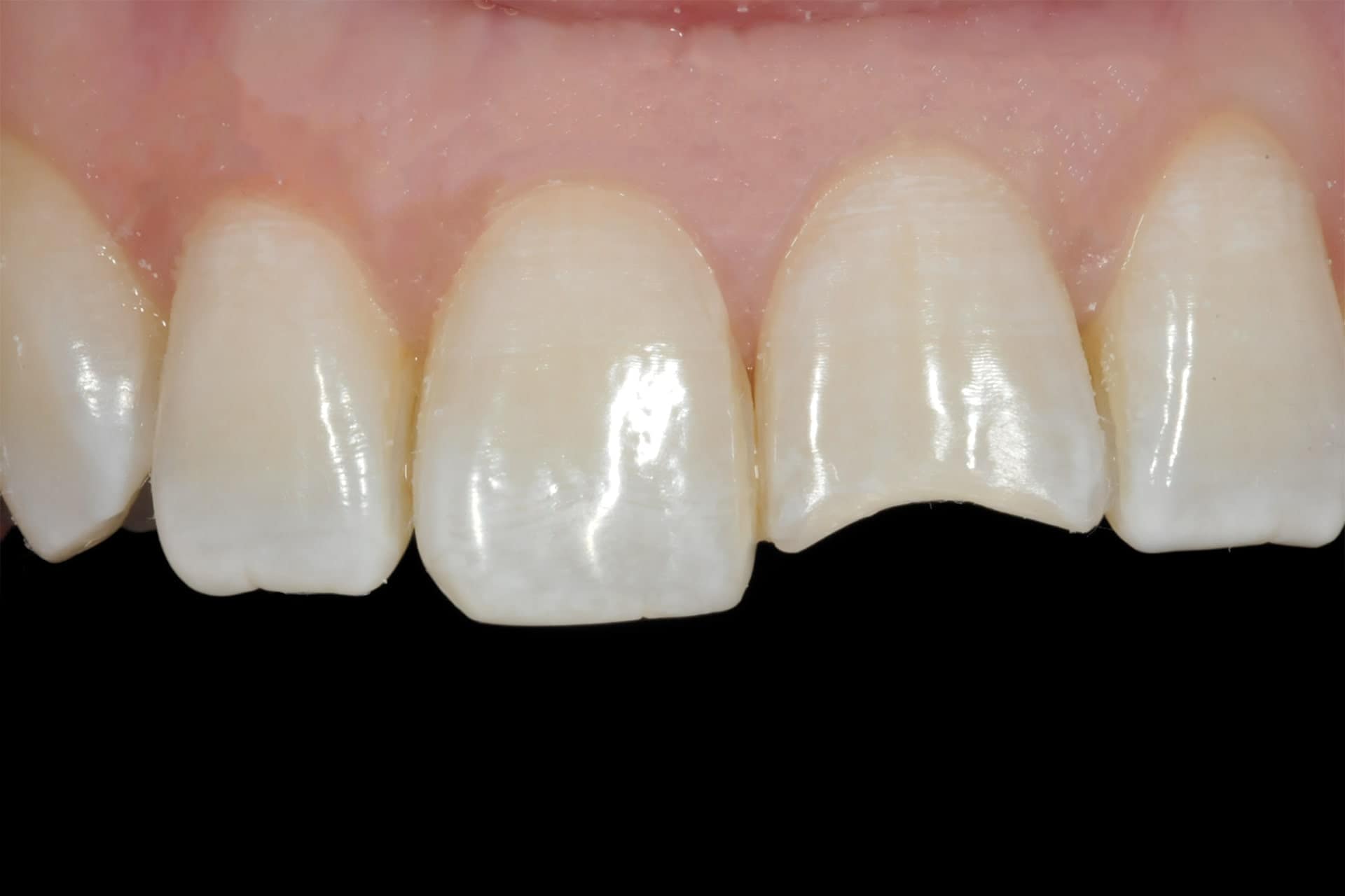 Cracked Tooth Syndrome - Dr. Cheng's Dental Tips