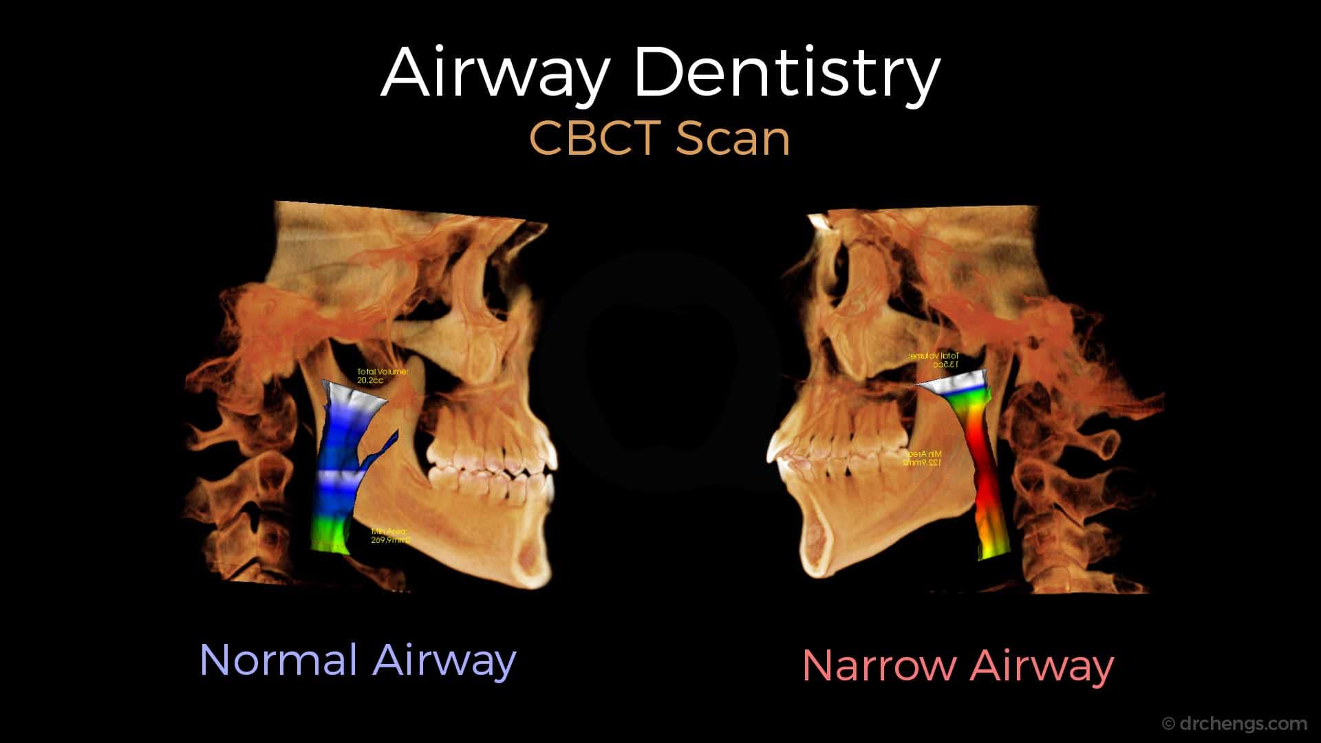 A Comprehensive Guide To Airway Dentistry - Dr. Cheng's Dental Tips